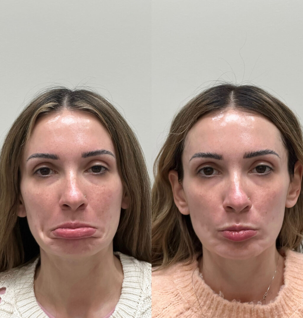 Lower Face Botox: Who It’s For & How It Works