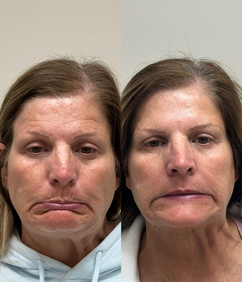 Lower Face Botox: Who It’s For & How It Works